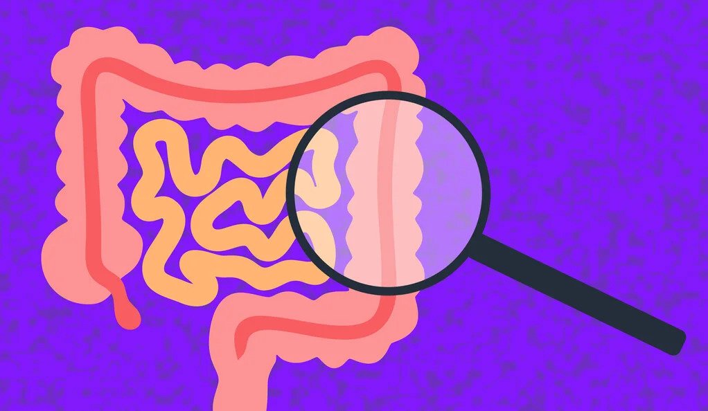 Study Reveals Potential Target for Precision Colorectal Cancer ...